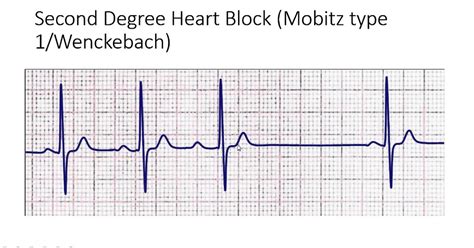 First Degree Av Block Was Present Second Degree Av Block Mobitz I