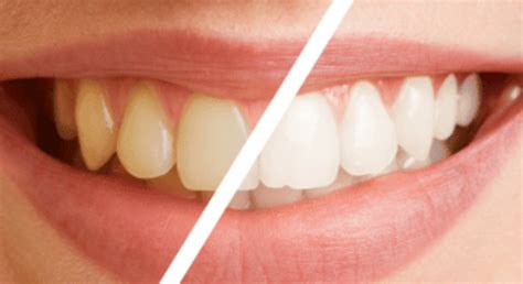 Bleaching From Tooth Whitening Protocols To Custom Tray Fabrication