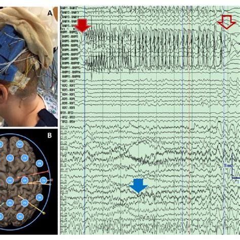 Simultaneous Intracranial And Scalp Eeg Ssieeg A Scalp Eeg