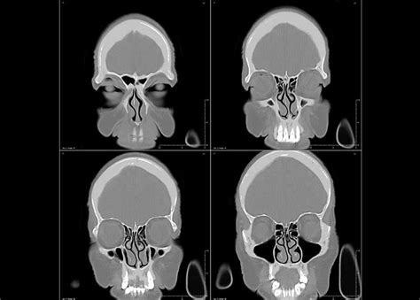 Image Guided Sinus Surgery Oc Ent Clinic Sinus Surgery