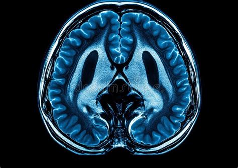 A Detailed Cross Sectional View Of The Human Brain From A Ct Scan Highlighting The Gray And