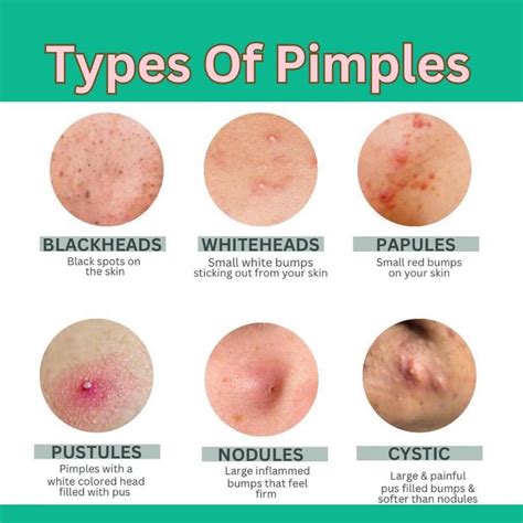Best 12 5 Things You Must Know Popping Pimples Artofit