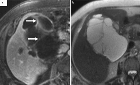 The Biliary Tree Radiology Key