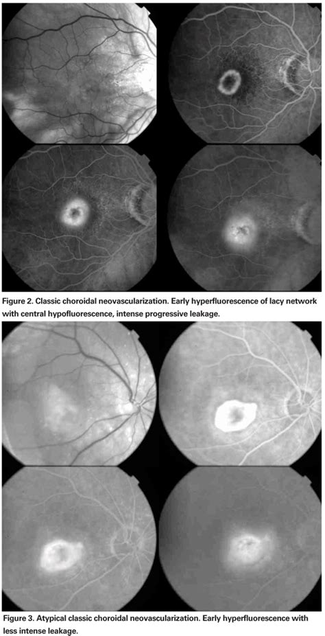 Fluorescein Angiography In Neovascular Amd