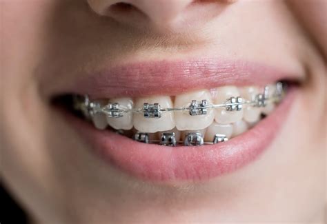 Twin Block Descubre Las Desventajas De Este Tratamiento Ortodóncico