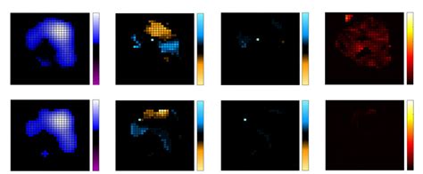 Patient No 3 With Ards Male 70 Years Old 165 Cm Height And 67 Kg