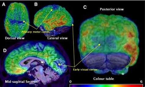 Figure 5 From Multimodal Imaging Of Human Early Visual Cortex By Combining Functional And