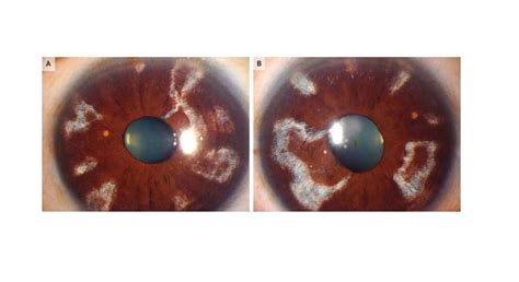 Wilmer Eye Institute Johns Hopkins Medicine On Linkedin Iris Atrophy In Sickle Cell Disease Nejm