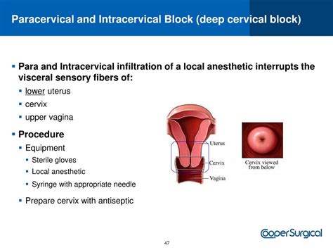 Ppt Global Endometrial Ablation Powerpoint Presentation Free Download Id 1028479