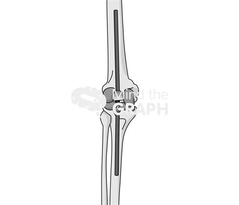 Exfix Abx Spacer Anteroposterior Bone Full