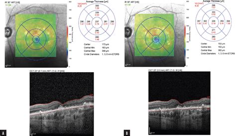 Geographic Atrophy Options In Clinical Therapy Retina Today