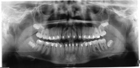 Ewing Sarcoma Jaw