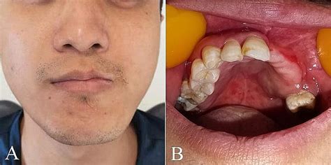 Rare Presentation Of Maxillary Osteonecrosis And Tooth Exfoliation