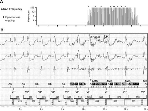 Cardiology Case Report On Dual Pacemaker Leads Shruti Iyengar Posted