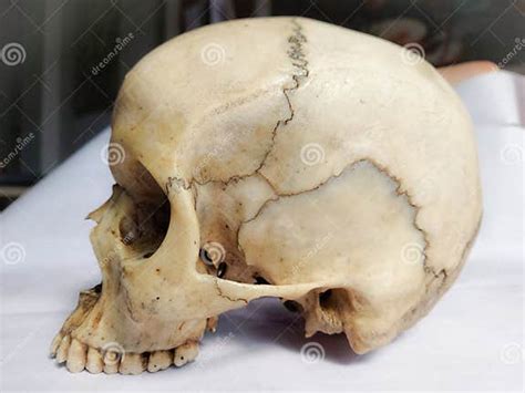 Original Human Skull Lateral View Showing Coronal Suture And Squamous