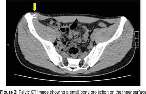 Figure 2 From Pelvic Osteochondroma Causing Meralgia Paresthetica