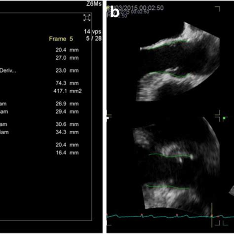 Auto Segmentation Programs Examples Of Automated Aortic Root