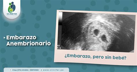 Embarazo Anembrionario Clinifer