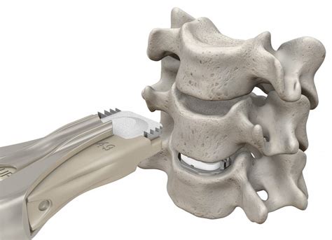 Mobi C® Artificial Cervical Disc Replacement Spinecare Medical Group