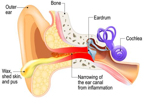 Outer Ear Infections — Ent Surgeon East Sydney Edgecliff Dr Marco