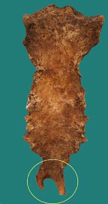 Bifid Xiphoid Process Semantic Scholar