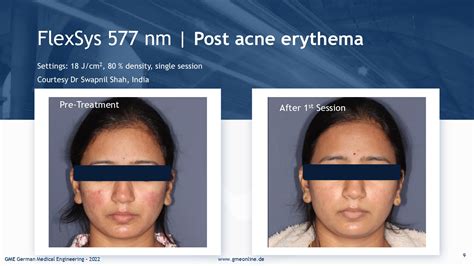 Flexsys 1550x577 Astermed Medikal