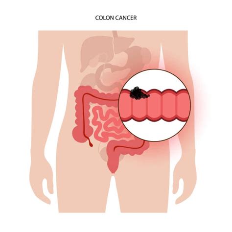 Colorectal Cancer Hk Dengyuemedicine