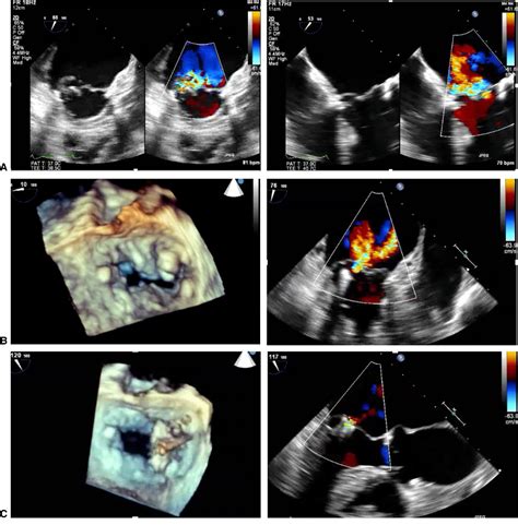 Figure 2 From Current Techniques For Severe Mitral Annular Calcification Semantic Scholar