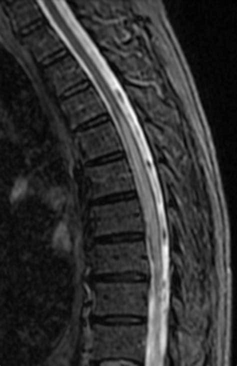 Sagittal Cervico Thoracic Stir Mri Sequence Increased Volume And Download Scientific Diagram