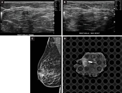 A Practical Guide To Wireless Breast Localization Devices Applied