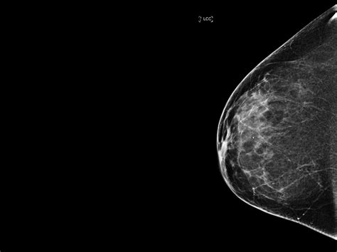 Breast Cancer Mammogram