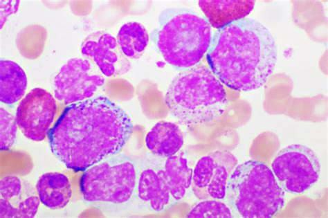 Chronic Myelogenous Leukemia