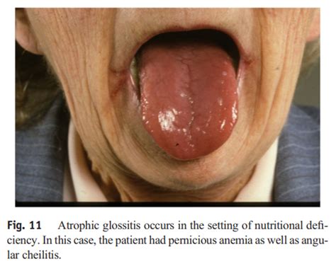 Pernicious Anemia Tongue