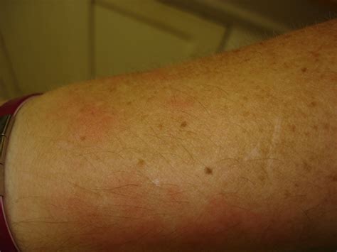 As My Fibro World Turns Red Thick Scaly Rash Photos