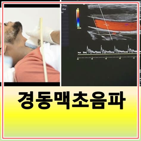 경동맥 초음파 검사 비용 30대 부터 네이버 블로그