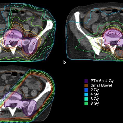 Radiotherapy Plan Of Each Technique Tested A Vmat B Vmat And