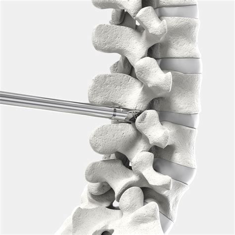 Corus Spinal System Lx Providence
