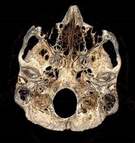 three‐dimensional reconstruction showing an occipital fracture with