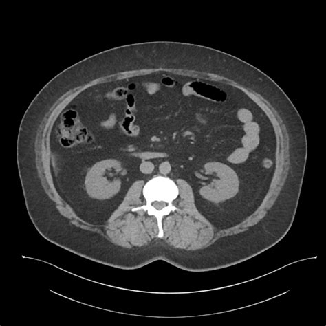 Radiopaedia Case Subhepatic Appendicitis Id 51297 Study 56974 Nc