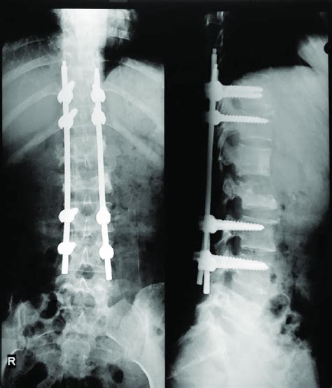 X Ray Lumbosacral Spine After Decompression Of Spinal Canal And