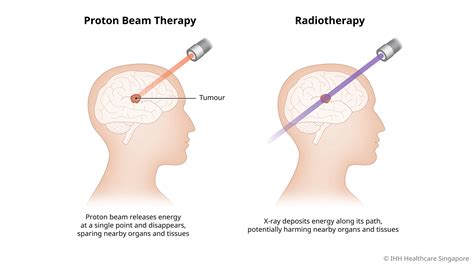 Proton Beam Therapy In Singapore Parkway Cancer Centre Singapore