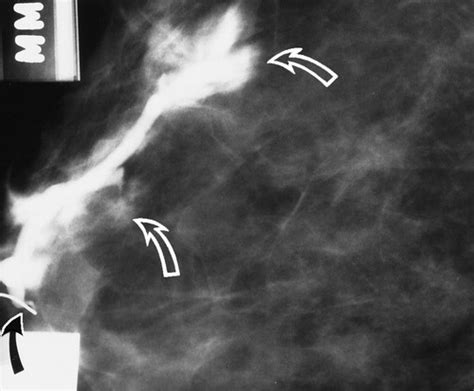 Ductography How To And What If Radiographics