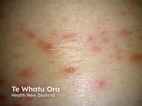Chickenpox Image Chickenpox Image