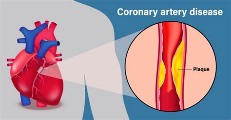 ผ่าตัดบายพาสหลอดเลือดหัวใจแผลเล็ก Minimally Invasive Cardiac Surgery