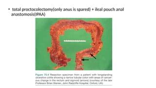 Management Principles Of Inflammatory Bowel Diseasepptx