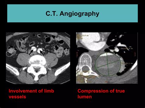 Type B Aortic Dissection Pptx