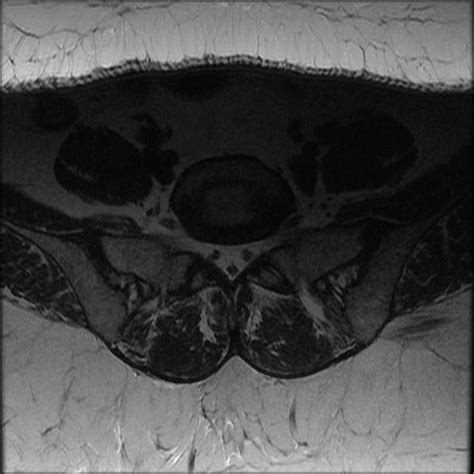 Radiopaedia Case Spinal Epidural Lipomatosis Id 87379 Study 103703