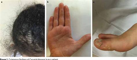 Figure 1 From A Novel Mutation In The Desmoplakin Gene In Two Female
