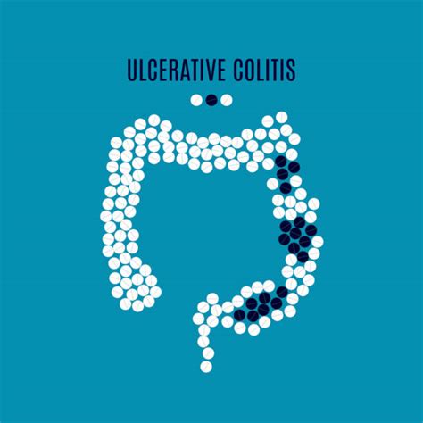 1100 Colitis Stock Illustrations Royalty Free Vector Graphics And Clip