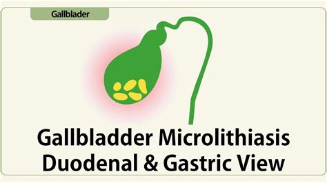 Gallbladder Microlithiasis Duodenal And Gastric View Youtube